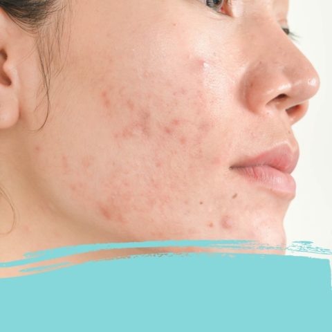 Acne behandeling Den Haag - CadanCe Huidinstituut