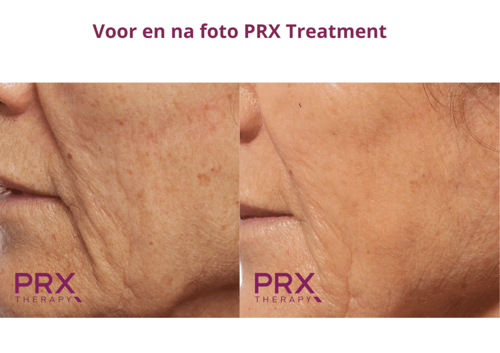 PRX-T33 TCA Peeling - CadanCe Huidinstituut